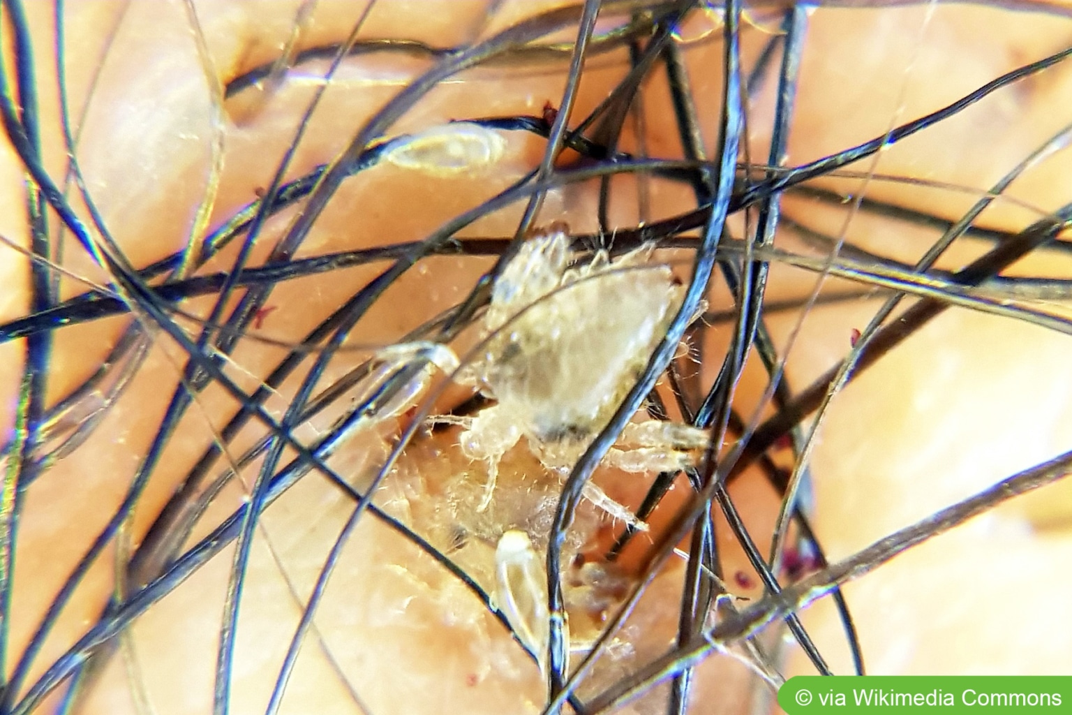 Mittel gegen Filzläuse - Behandlung - Hausgarten.net